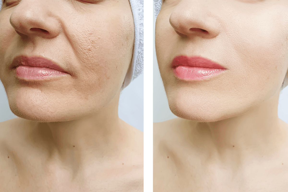 Juvederm Before and After: Visible Results, Lasting Impact